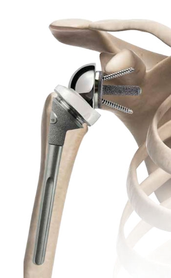 Reverse Shoulder System | Trabecular Metal Reverse Shoulder System ...